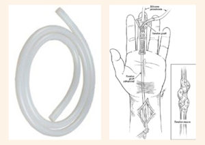 Silicone Implants in Plastic Surgery
